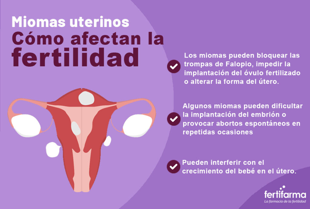 Miomas Uterinos. Cómo afectan la Fertilidad
